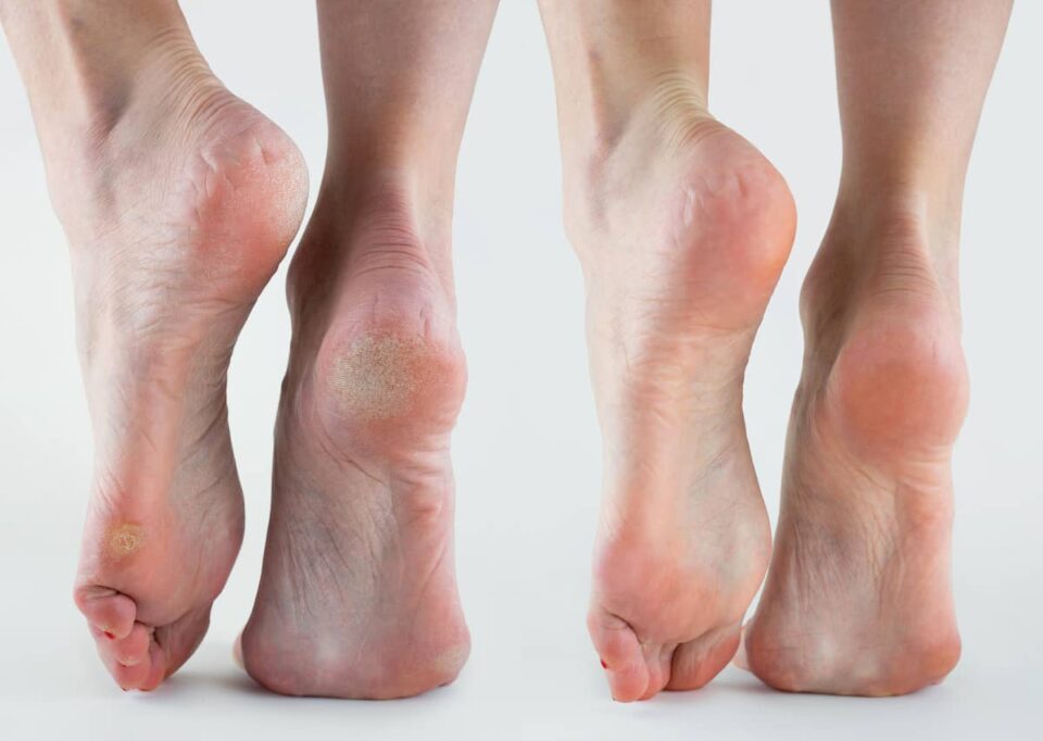 The Impact of Poor Foot Health - Feet First Clinic
