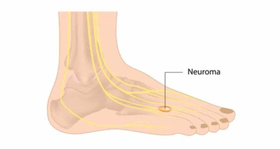 5 Causes for Numb Feet or Toes - Feet First Clinic