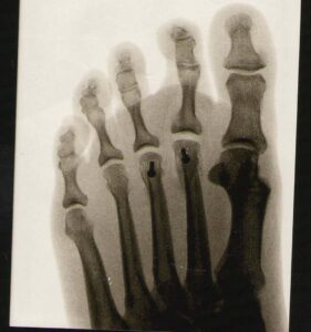 Plantar Plate Tear, Explained - Feet First Clinic