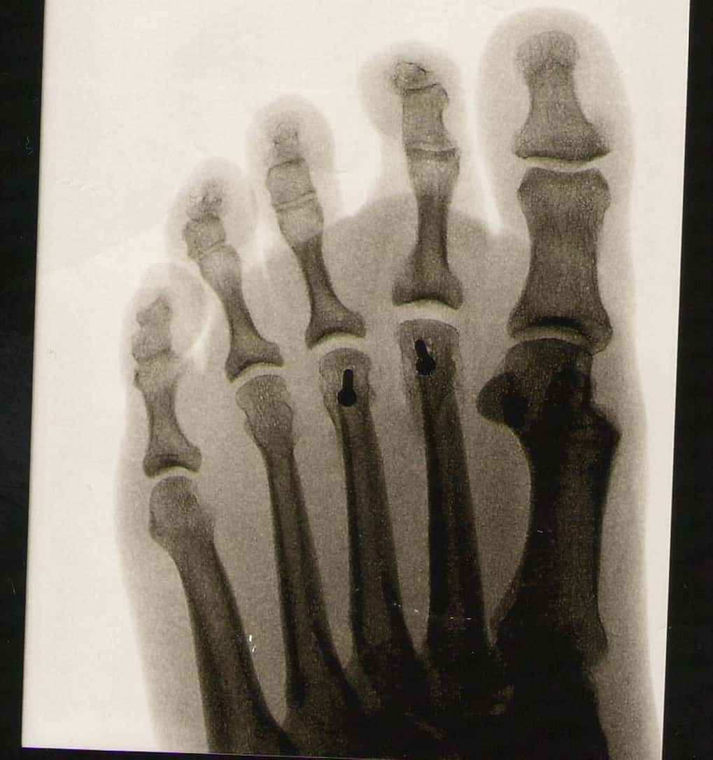 Plantar Plate Tear, Explained - Feet First Clinic