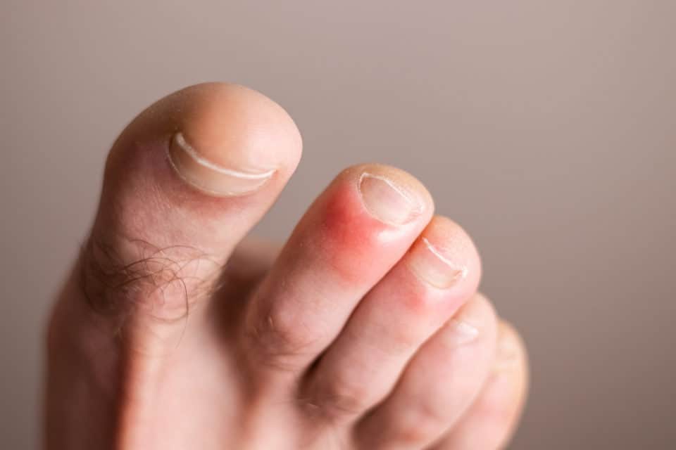 Red Toe Rash: Could it be COVID Toes? - Feet First Clinic