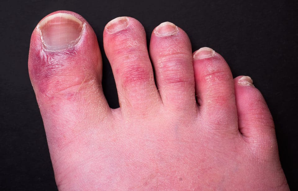 Red Toe Rash: Could it be COVID Toes? - Feet First Clinic