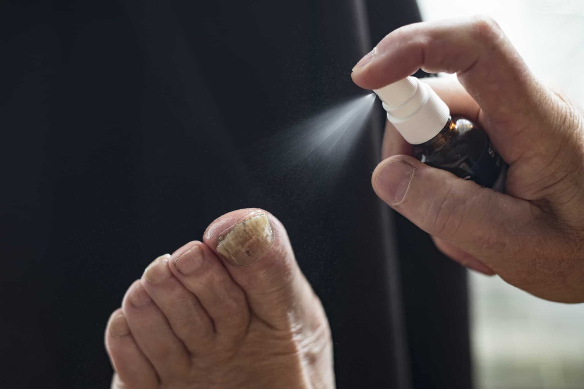 Causes of Curled Toenails - Feet First Clinic