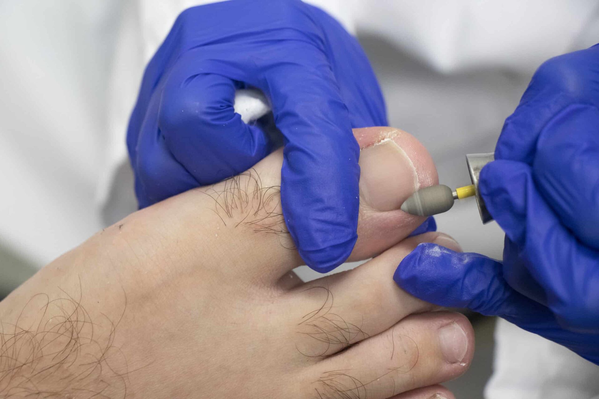 How to Treat a Cracked Toenail - Feet First Clinic