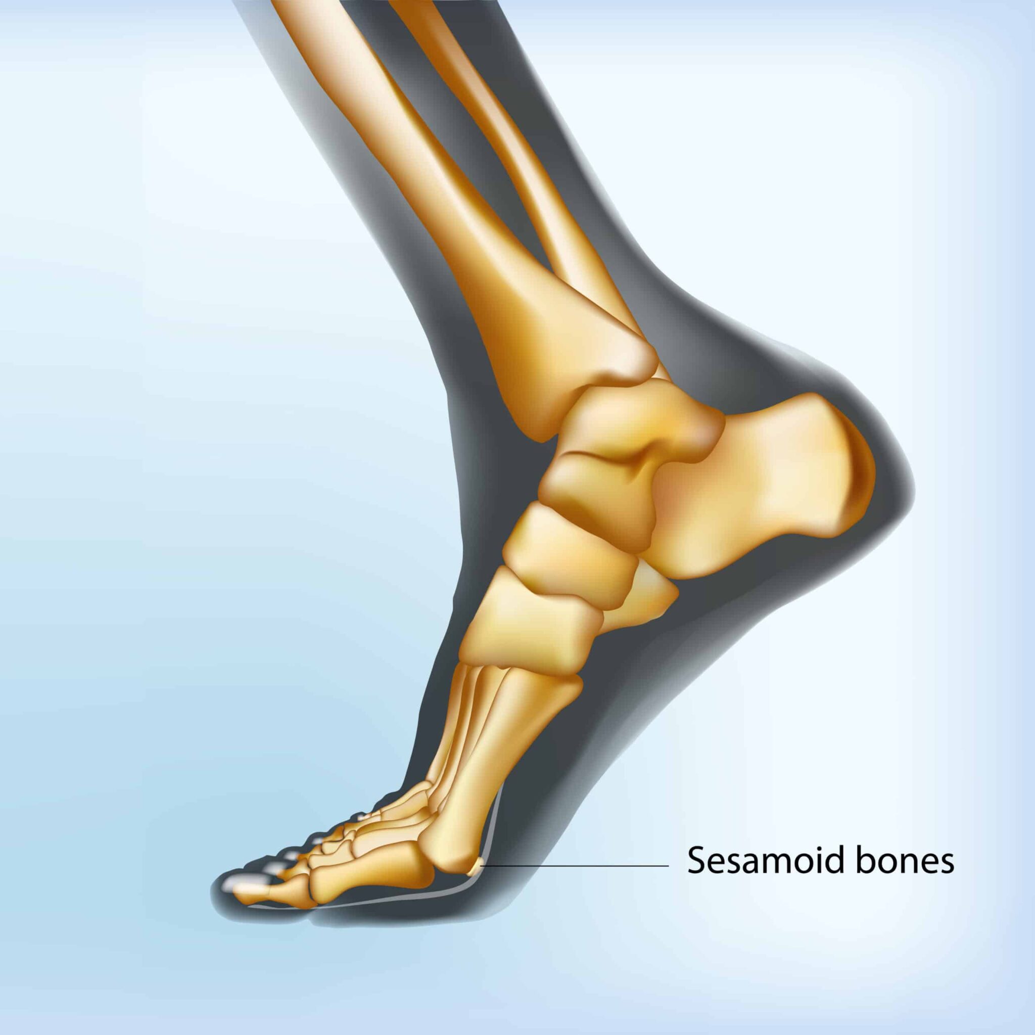Sesamoiditis: Explained - Feet First Clinic