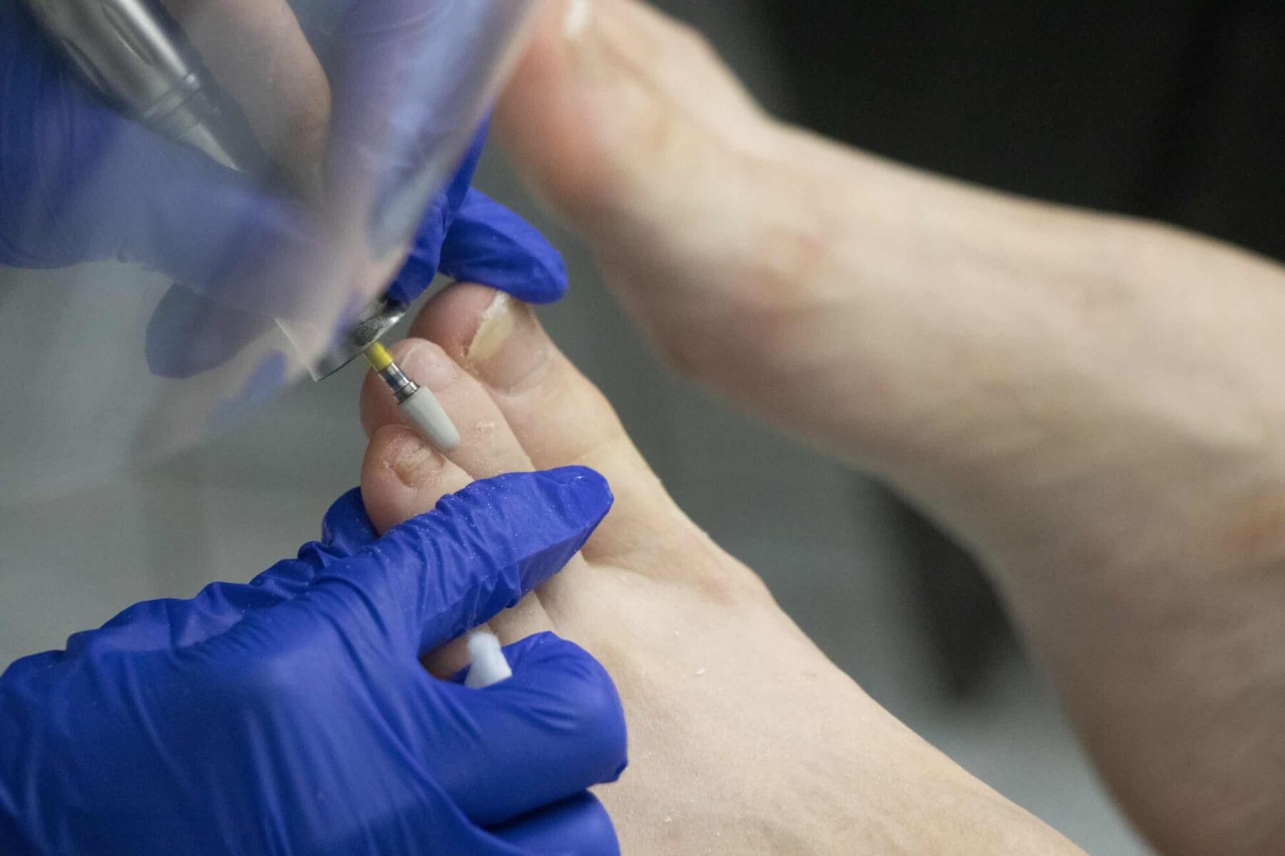 5 Causes of Black Toenails - Feet First Clinic