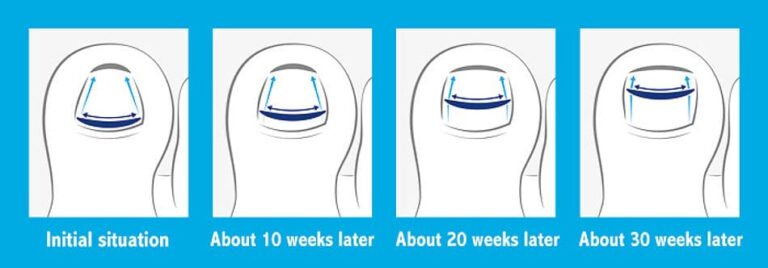 Painless Ingrown Toenail Treatment: Onyfix - Feet First Clinic