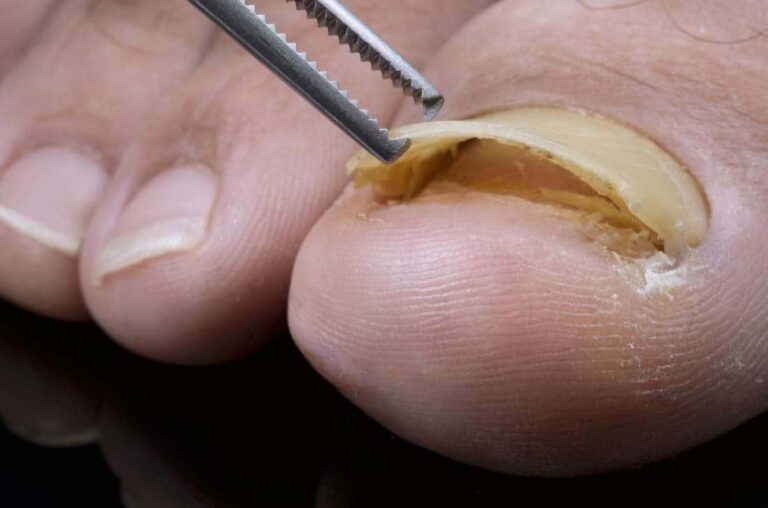Help! My Toenail is Falling Off! - Feet First Clinic