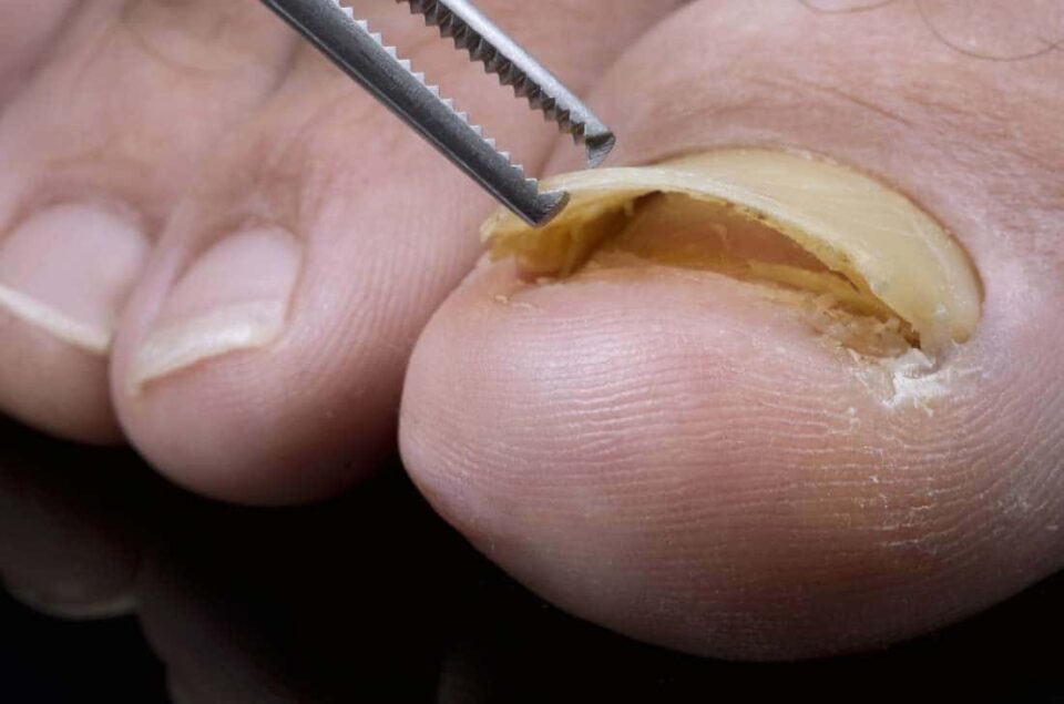 Help! My Toenail is Falling Off! - Feet First Clinic