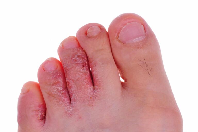 Why Do I Have Red Toes? An Overview, Causes, And Prevention - Feet ...