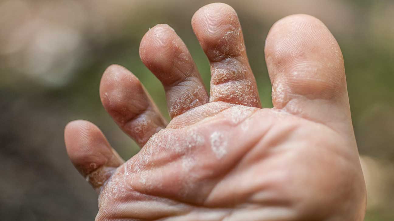 5 Reasons Why Your Feet Are Peeling - Feet First Clinic