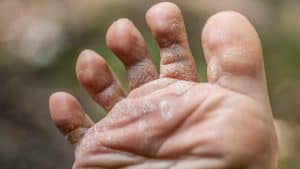 Itchy Feet: Symptoms, Causes, and Treatments - Feet First Clinic