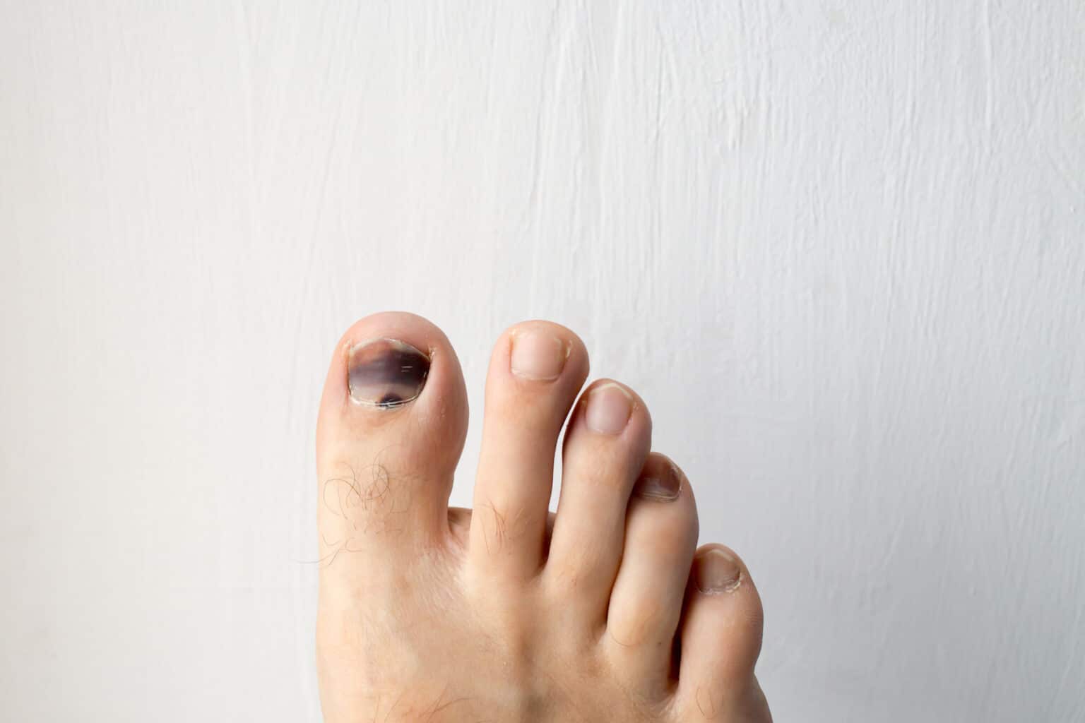 Black Spot on Toenail: Should You Be Worried? - Feet First Clinic