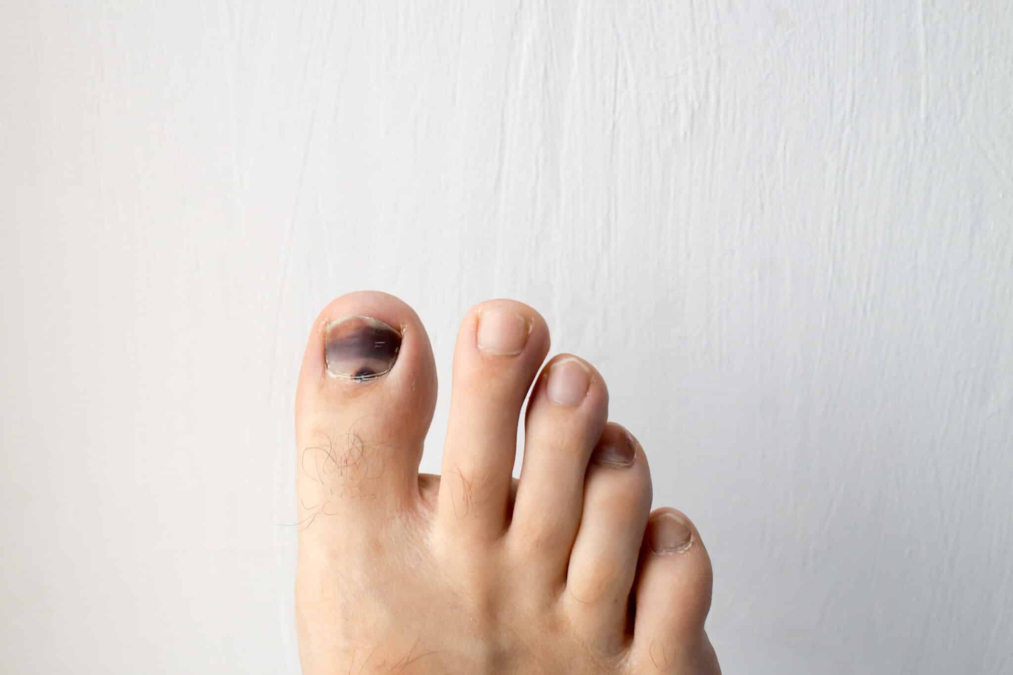 Black Spot on Toenail: Should You Be Worried? - Feet First Clinic