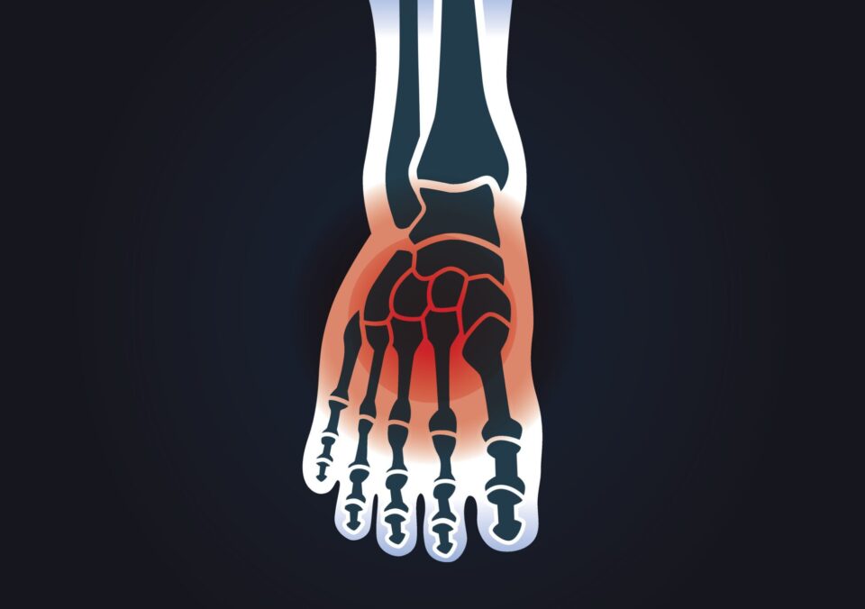 Understanding the Bones of the Foot: A Comprehensive Guide - Feet First ...