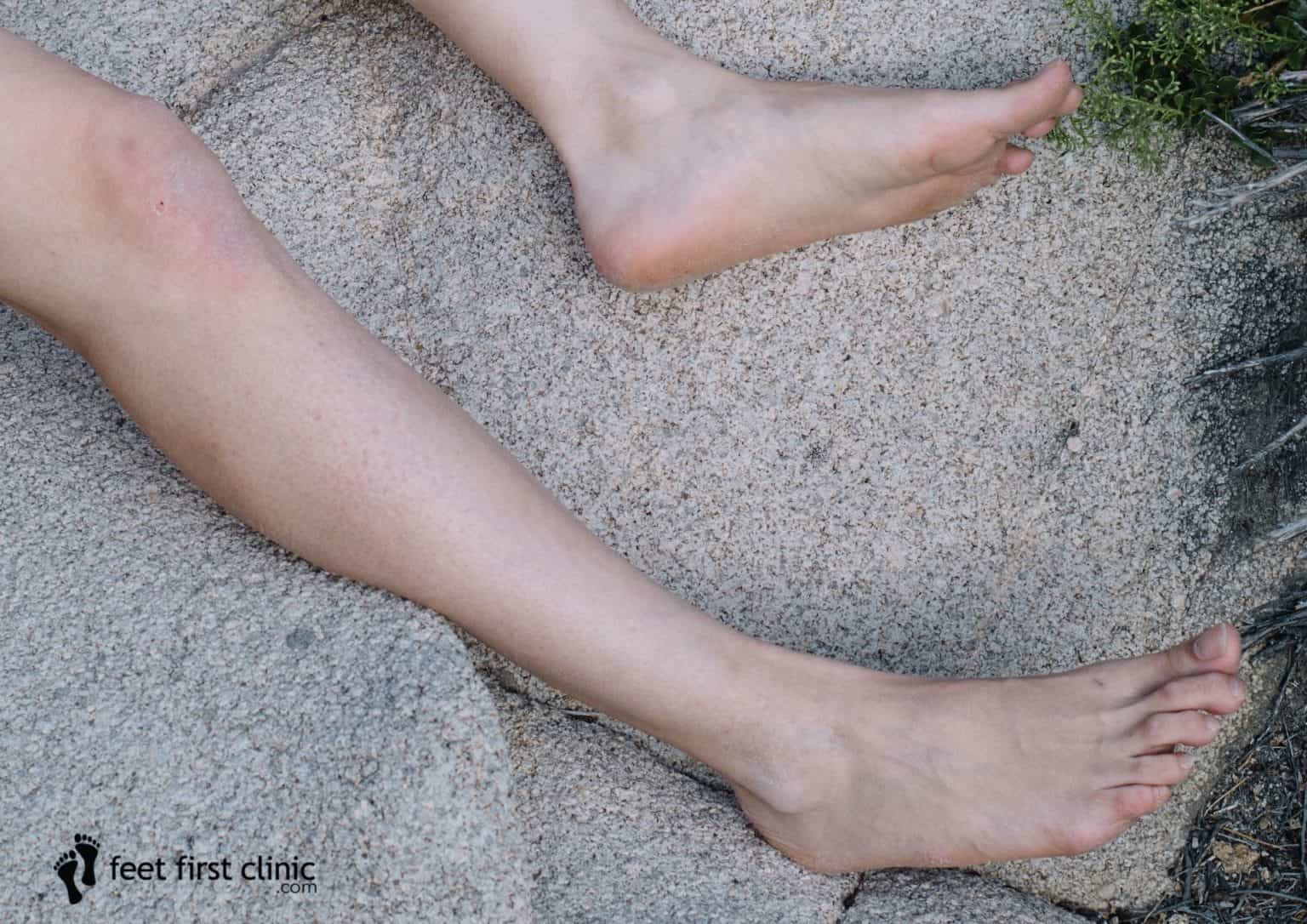 Ganglion Cyst On Top Of The Foot: What Is It? - Feet First Clinic