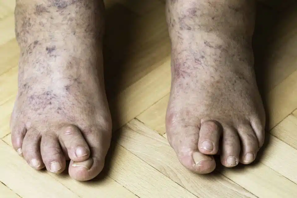 Flexor Tenotomy - Feet First Clinic