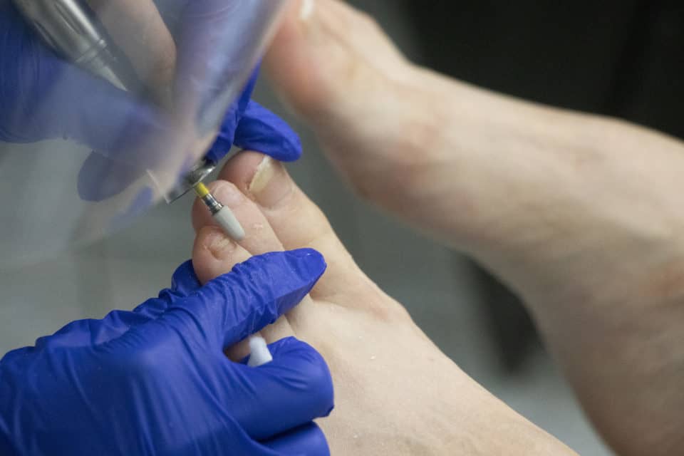 5 Causes of Black Toenails - Feet First Clinic