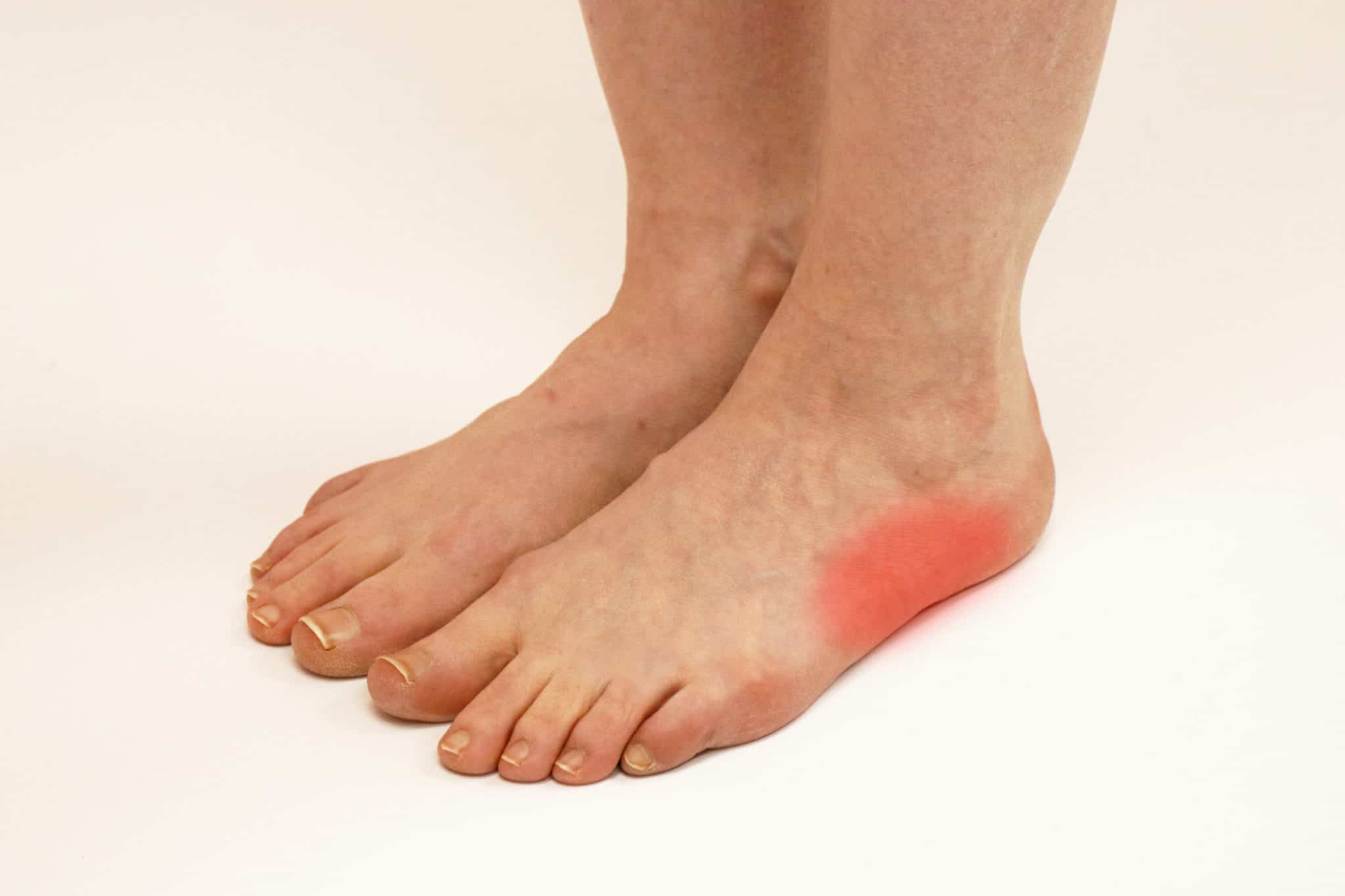 Cuboid Syndrome: Causes, Symptoms, and How a Chiropodist Can Help ...