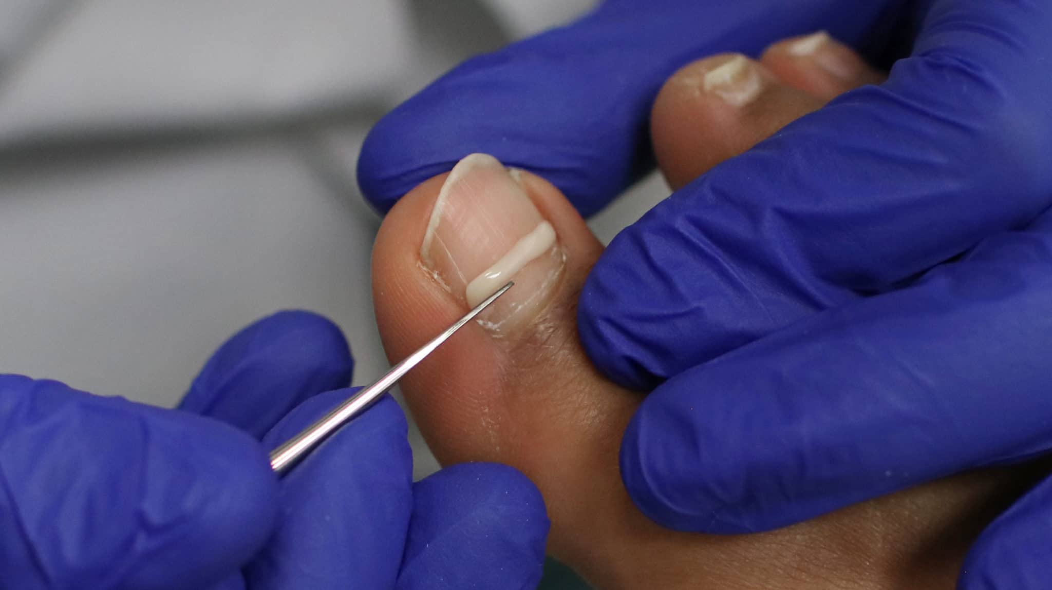 Painless Ingrown Toenail Treatment: Onyfix - Feet First Clinic