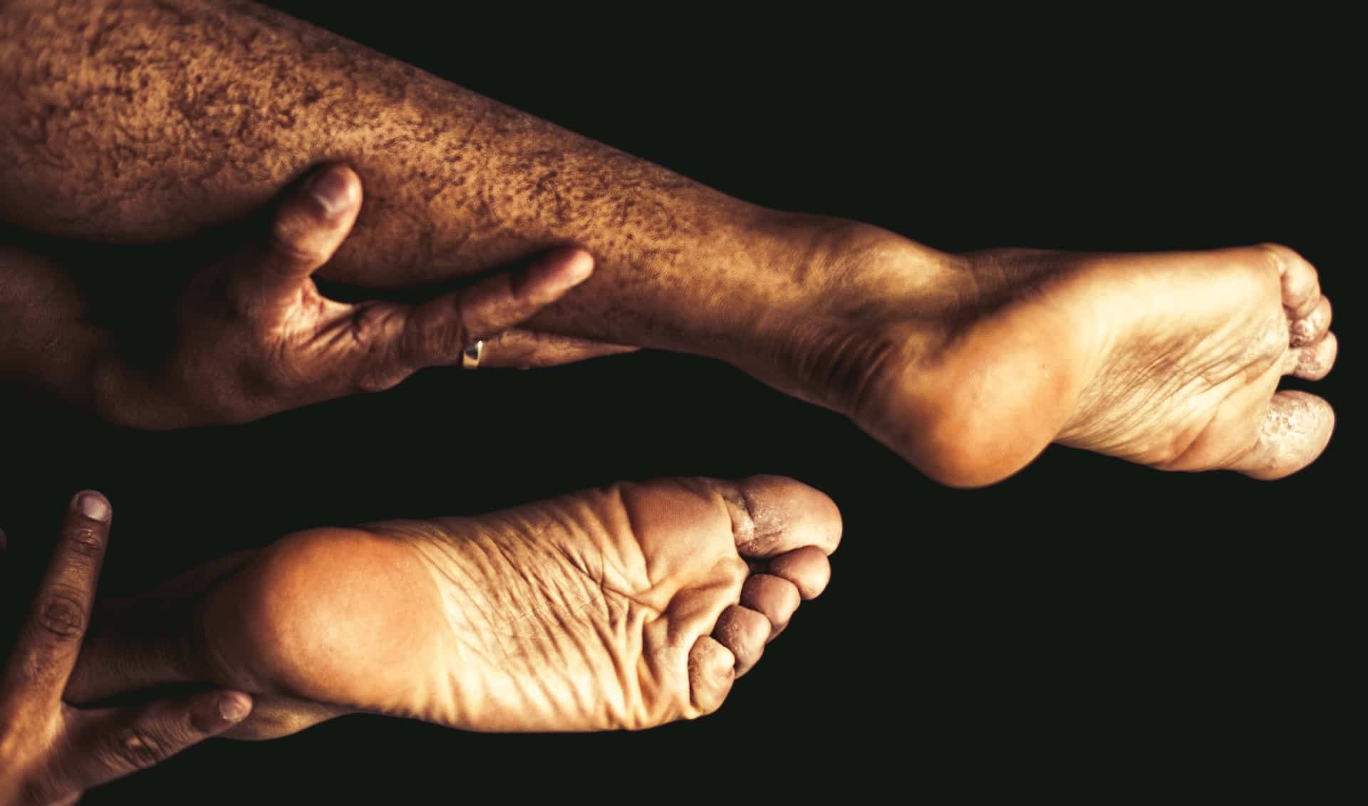 Skin Peeling on Feet: Causes and Remedies - Feet First Clinic