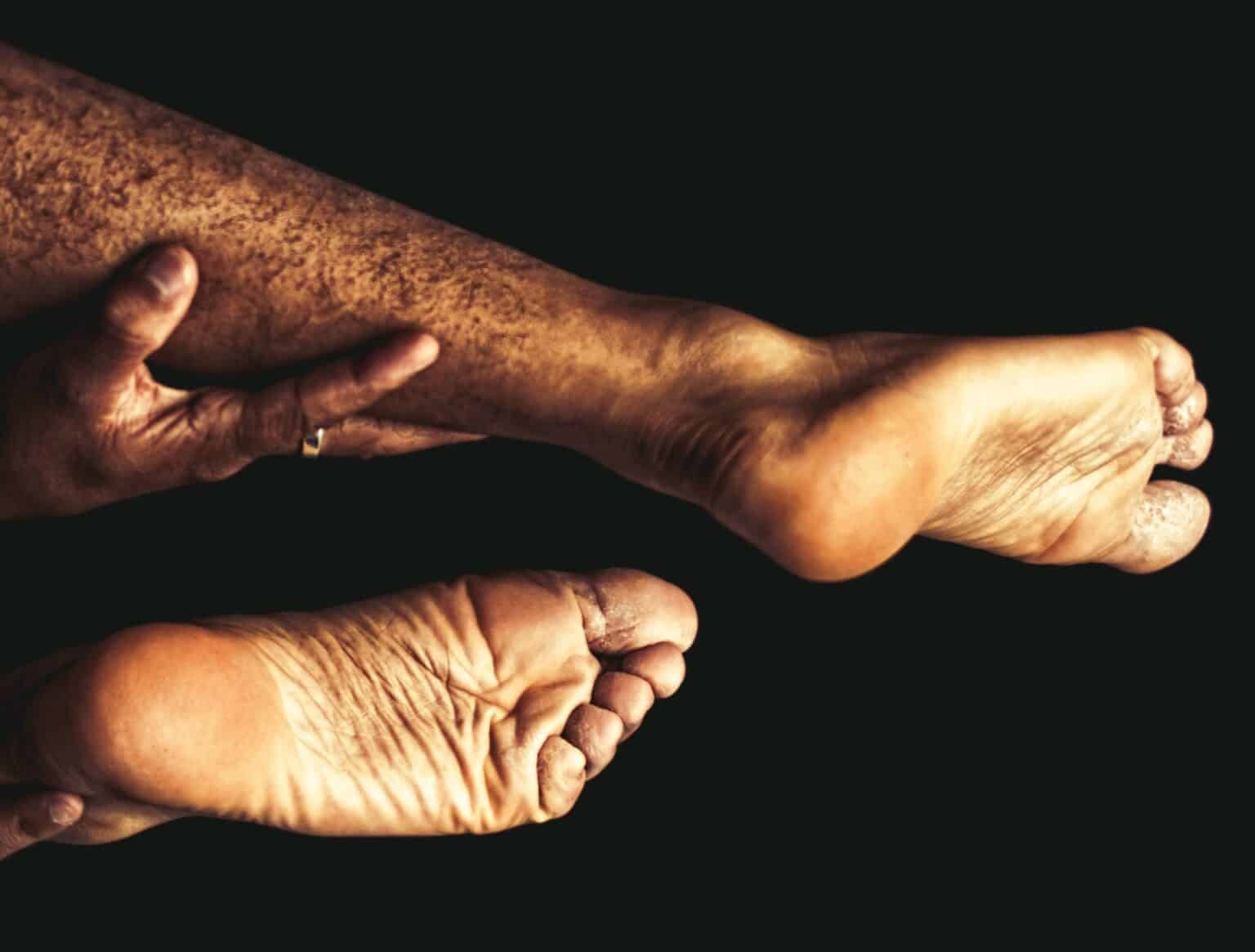 Skin Peeling on Feet and Effective Remedies | Feet First Clinic