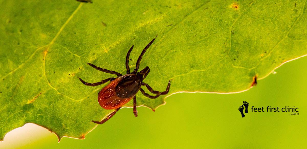 How To Protect Your Feet and Legs From Ticks - Feet First Clinic