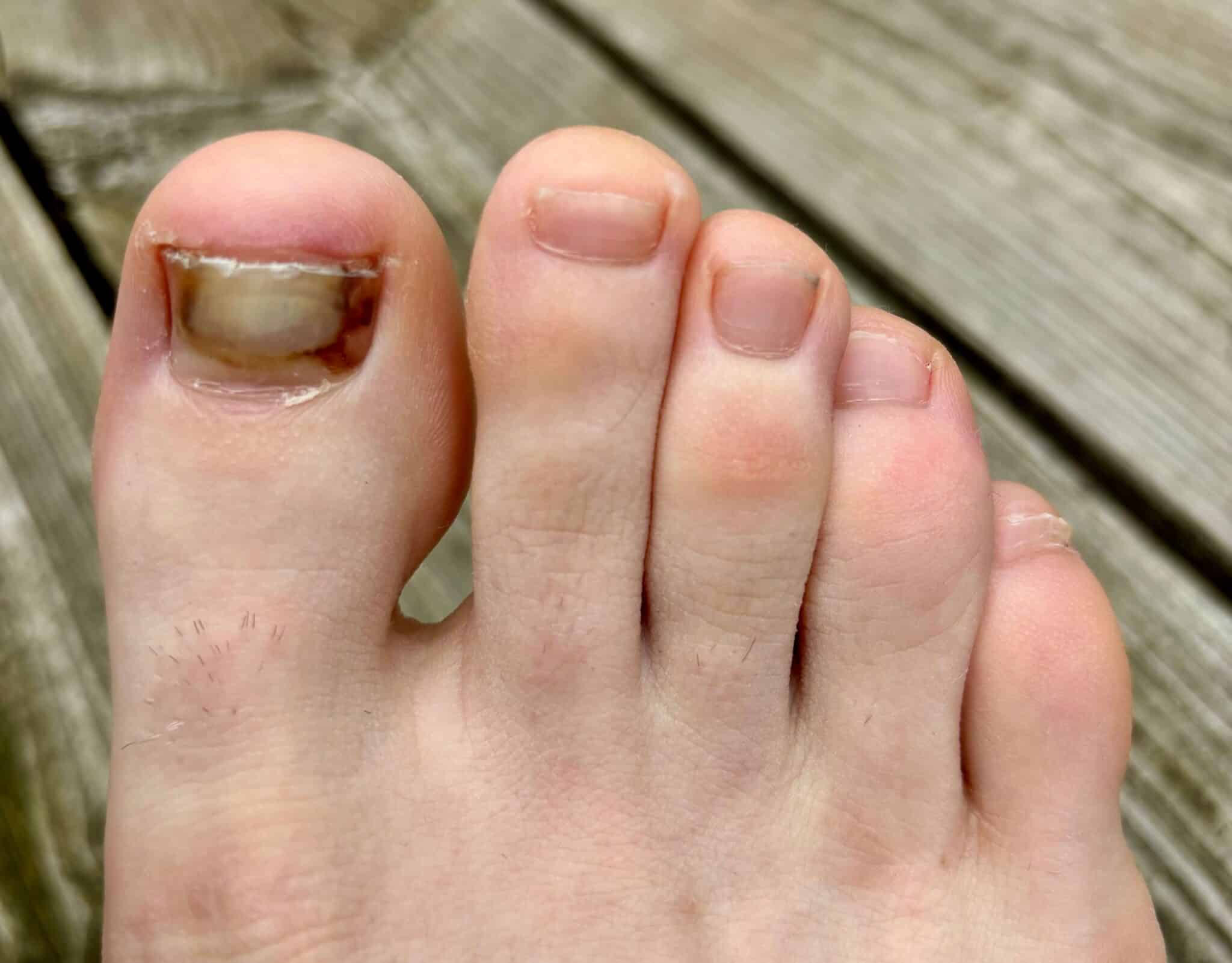 Tips For When Your Toenail Is on The Verge Of Falling Off - Feet First ...