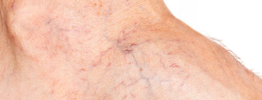 Varicose Veins: Causes, Symptoms and Treatment - Feet First Clinic