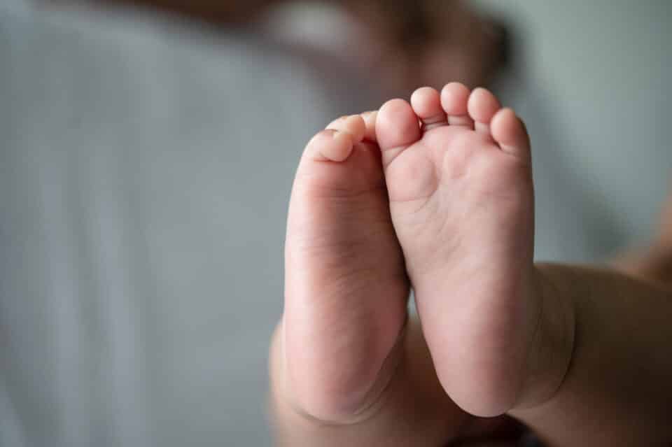 Polydactyly: Understanding the Rare Phenomenon of a Sixth Toe - Feet ...