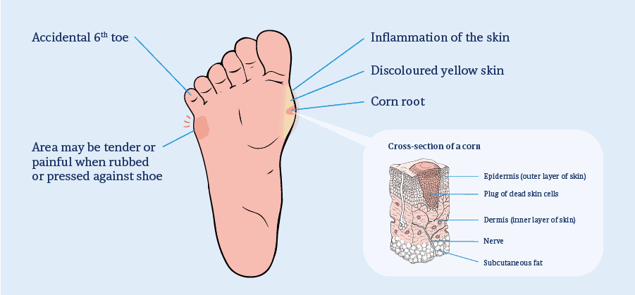Corns: What Are They? - Feet First Clinic