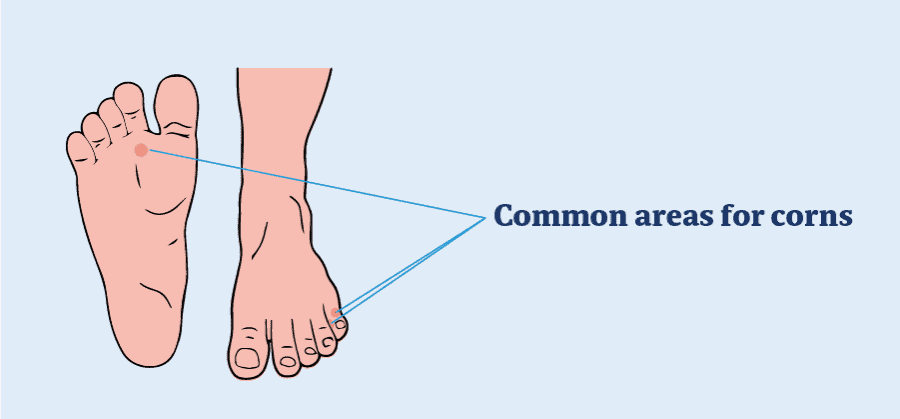 Corns: What Are They? - Feet First Clinic