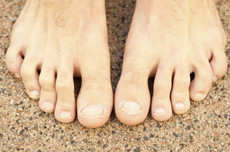 Hammer Toes | Foot Specialist Toronto | Feet First Clinic