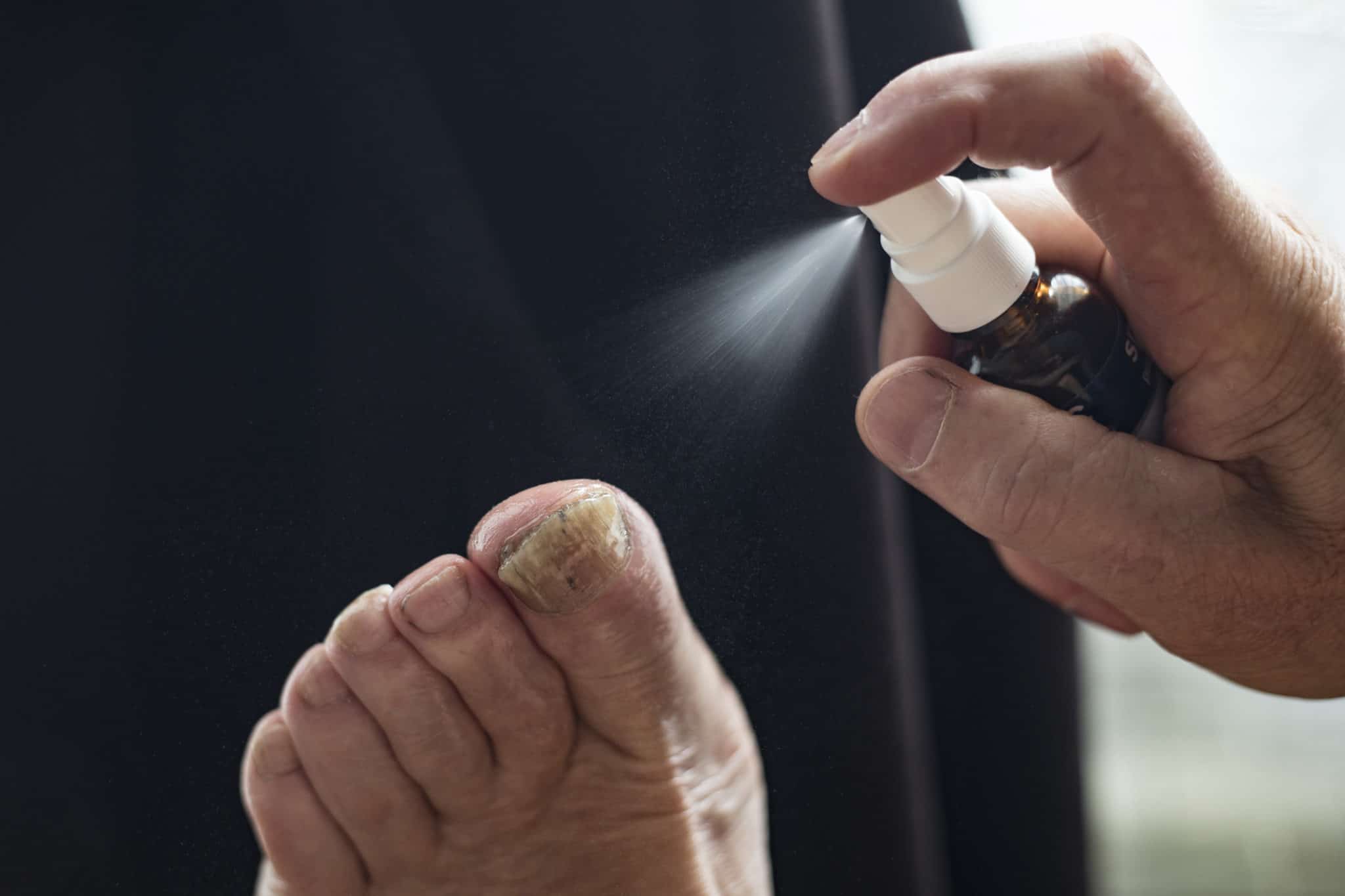 Causes of Curled Toenails - Feet First Clinic