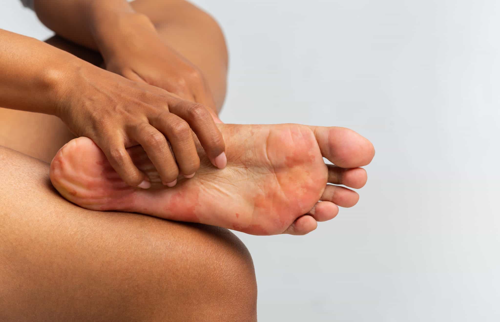 Contact Dermatitis and Your Feet - The "What", "Why," And "How" of Skin ...