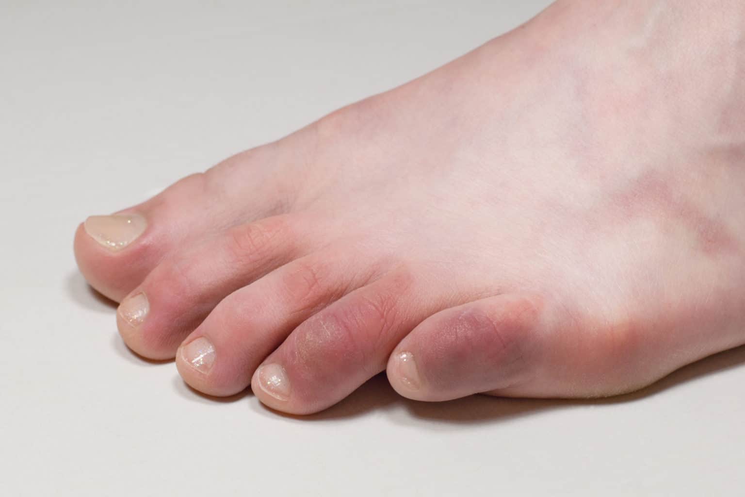 Why Do I Have Red Toes? An Overview, Causes, And Prevention - Feet ...