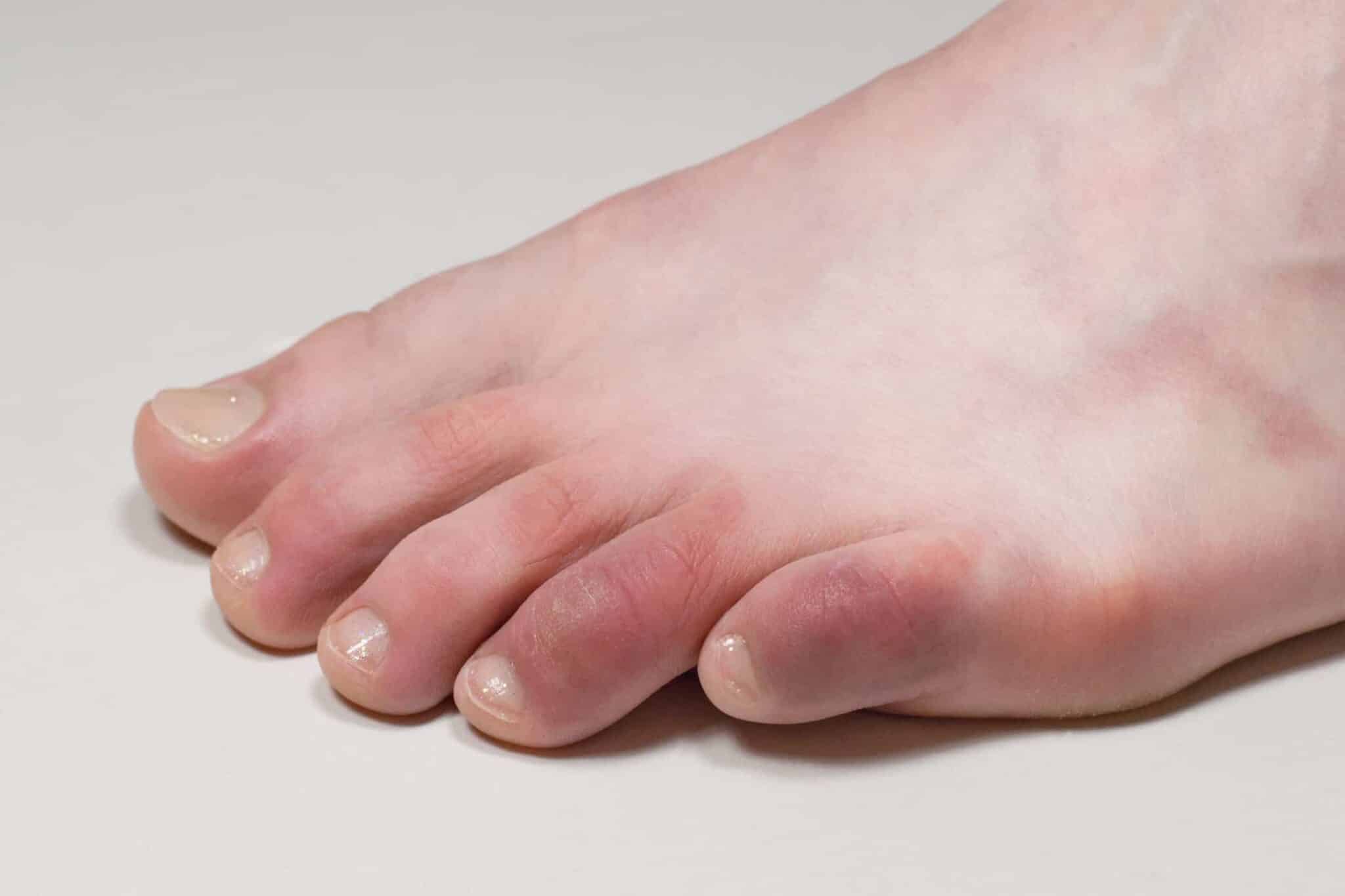 Why Do I Have Red Toes? An Overview, Causes, And Prevention - Feet ...