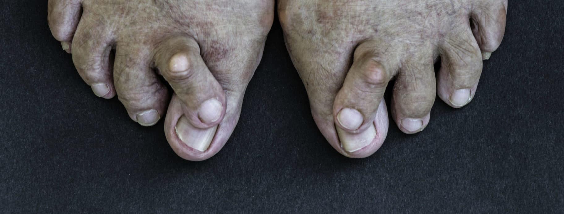 Flexor Tenotomy - Feet First Clinic