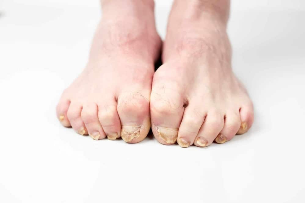 Causes Of Curled Toenails Feet First Clinic