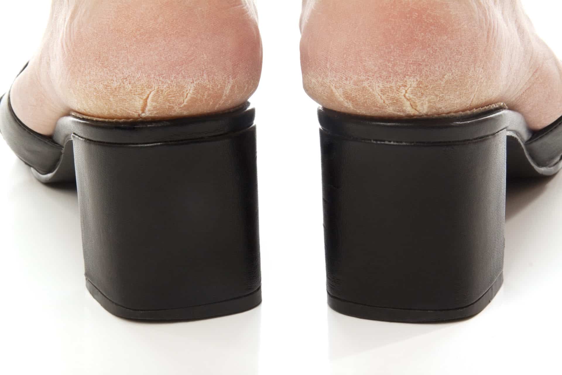 Cracked Heels and Heel Fissures: The Dangers and What You Can Do - Feet ...