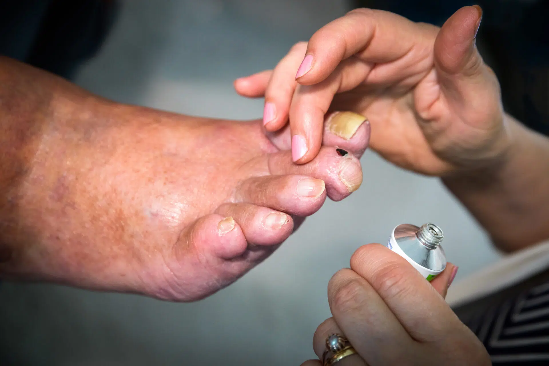 Curly Toenails: What They Indicate and How to Manage Them - Feet First ...