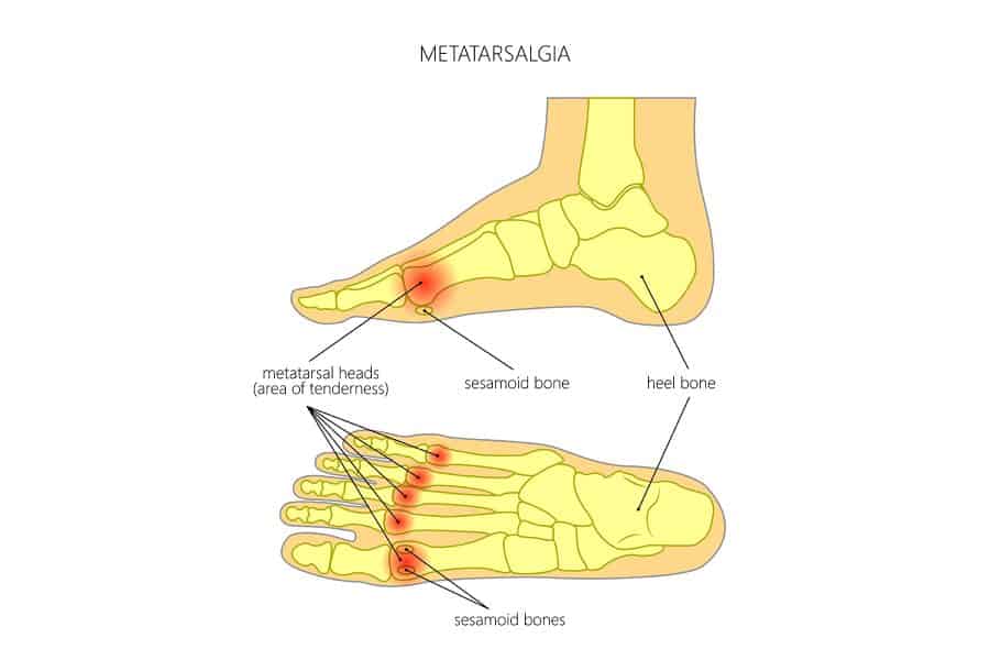 Why Do I Have Pain in The Ball Of My Foot? - Feet First Clinic
