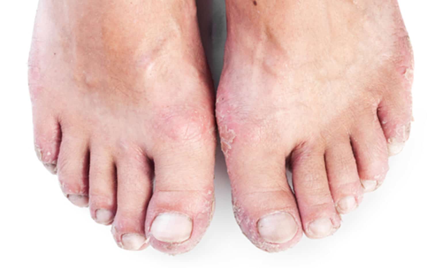 Itchy Feet: Symptoms, Causes, and Treatments - Feet First Clinic