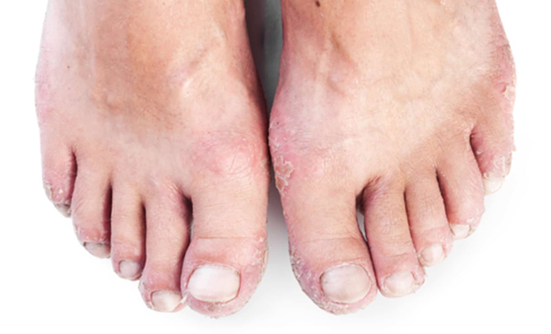 Itchy Feet: Symptoms, Causes, and Treatments - Feet First Clinic