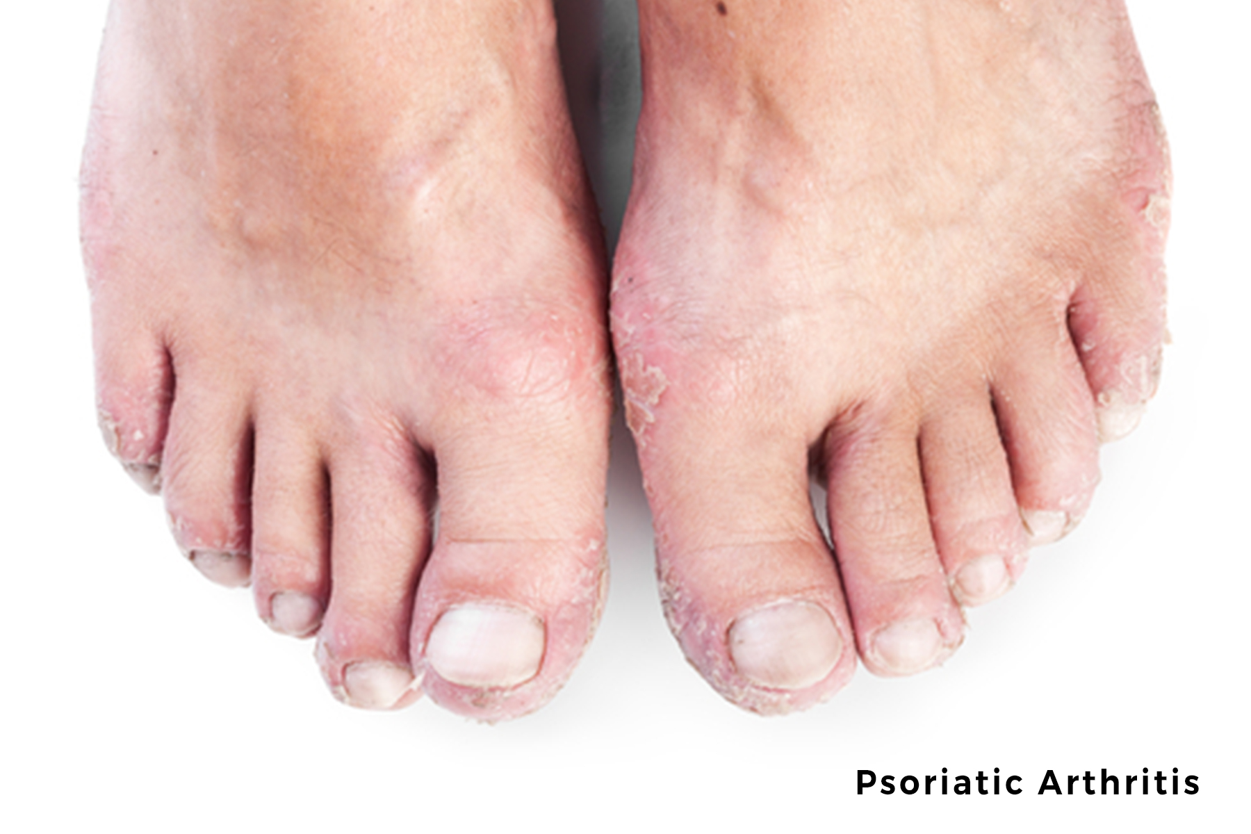 Psoriatic Arthritis Foot Specialist Toronto Feet First Clinic