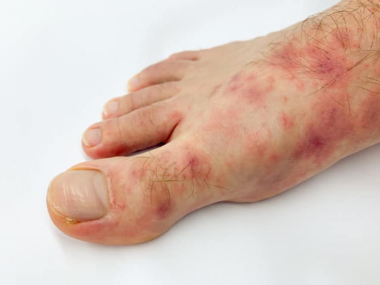 Red Toe Rash: Could it be COVID Toes? - Feet First Clinic