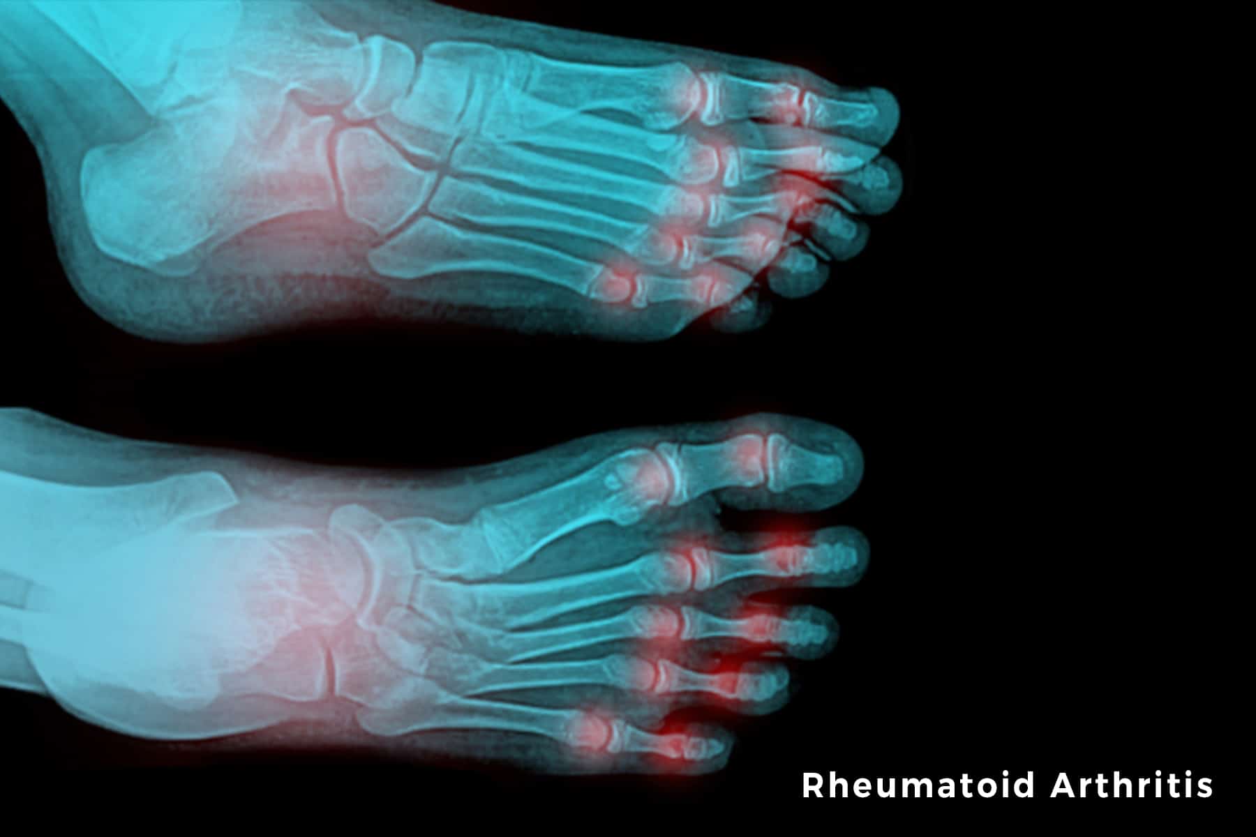 Different Types of Arthritis - Feet First Clinic