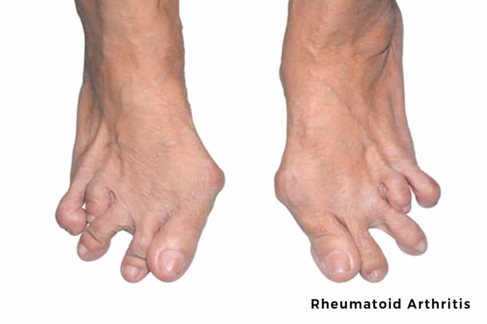 Rheumatoid Arthritis | Foot Specialist Toronto | Feet First Clinic