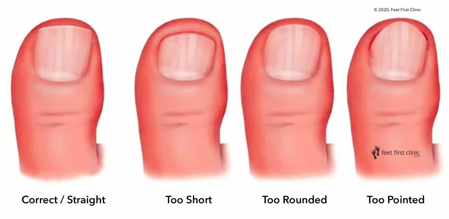 How To Cut Your Toenails Like A Professional Feet First Clinic